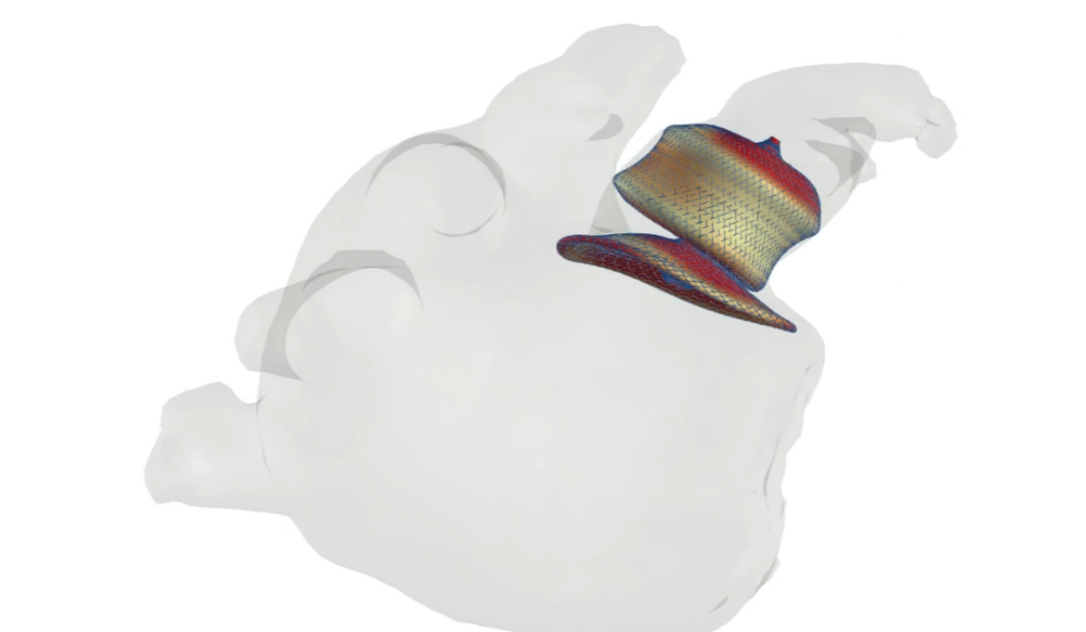 FEops HEARTguide authorized by FDA for unprecedented LAAo planning ...