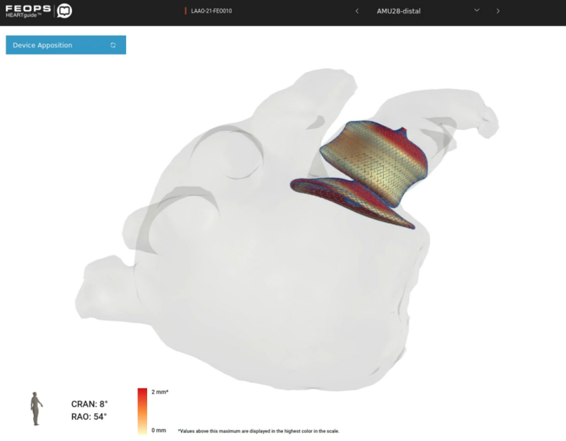 PREDICT-LAA trial enrolls first patient | Capricorn Partners