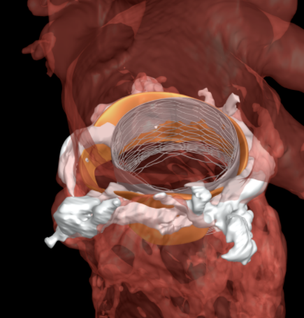 FEops HEARTguide receives FDA clearance for LAAo planning capabilities ...